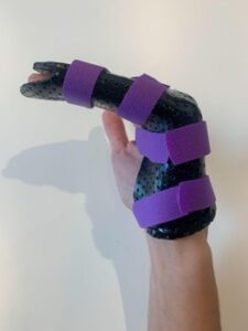 What is a proximal phalanx fracture? - Hand Therapy Group